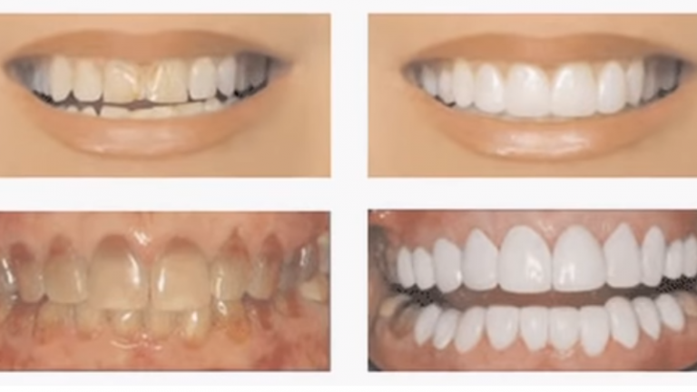 5 Things Everyone Should Know Before Getting Dental Veneers | Veneers Dubai