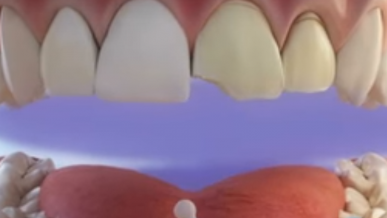 How Dental Veneers Are Installed On Teeth In Four Stages Veneers Dubai