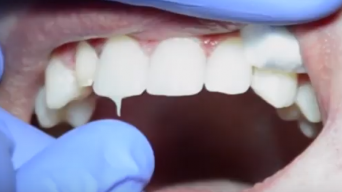 How Dental Veneers Are Installed On Teeth In Four Stages Veneers Dubai