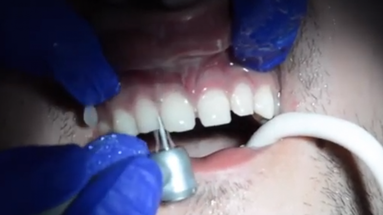 How Dental Veneers Are Installed On Teeth In Four Stages Veneers Dubai