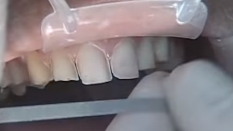 All About Empress Veneers: Advantages, Disadvantages, Indication, Cost